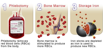 Therapeutic Phlebotomy Explained - E Phlebotomy Training